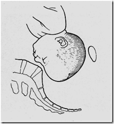 INFORMASI REPRODUKSI: DISTOSIA AKIBAT KELAINAN JANIN